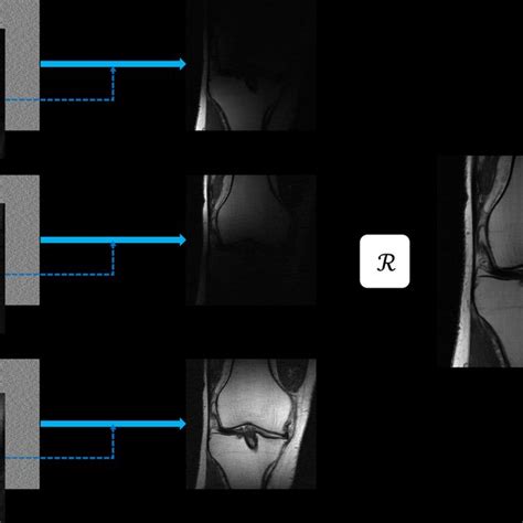 illustration of score pocs applied to parallel imaging coil images are