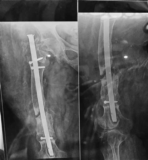 Vancouver Classification Is A Good Method For Periprosthetic Fracture