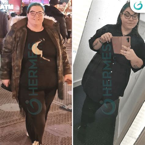 Before And After Hermes Clinics