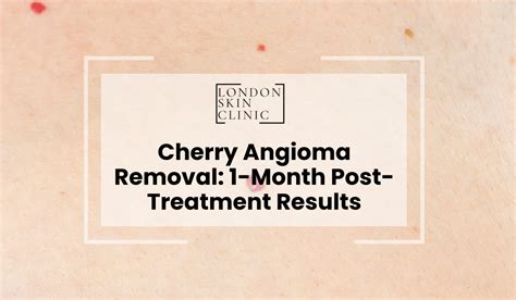 Cherry Angioma Removal 1 Month Post Treatment Results London Skin Clinic