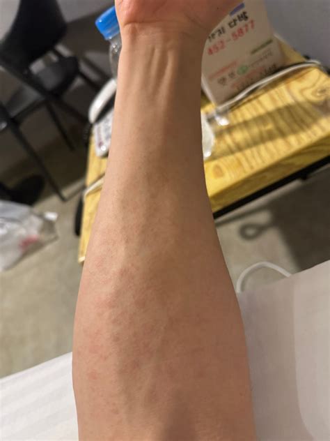 피부 알레르기 지식in