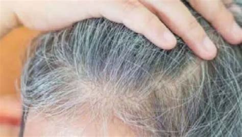 Grey Hair Treatment Include These Things In Your Daily Diet To Prevent