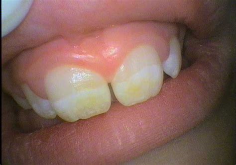 Enamel Hypocalcification Vs Enamel Hypoplasia