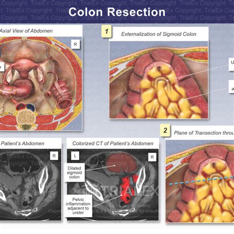 Colon Resection Trialquest Inc Colon Resection Trialquest Inc