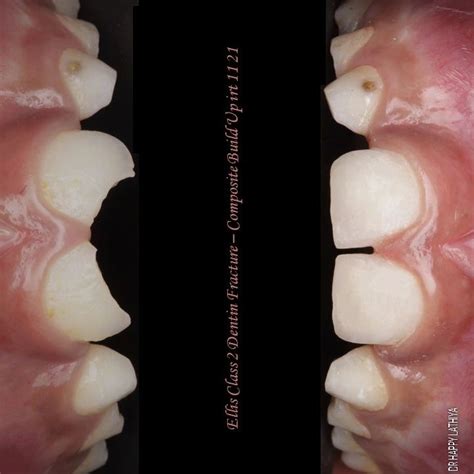 ️ Ellis Class 2 Dentin Fracture Build Up With Composite ️ Dr Happy