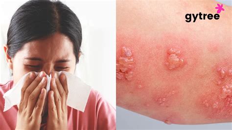 Is Condom Allergy A Real Thing