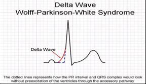 Wpw Syndrome Delta Wave