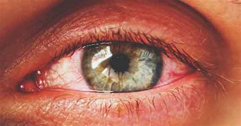 Seasonal Allergic Conjunctivitis