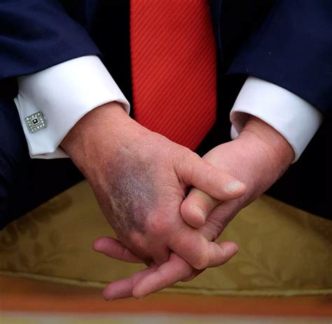 Full List Of Donald Trumps Health Fears Over The Past 12 Months Amid