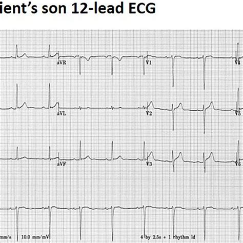 12‐lead Ecg Recordings A Index Patient Resting Heart Rate Was