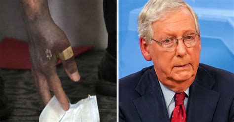 Mitch Mcconnells Hand Discolored He Says Hes Healthy