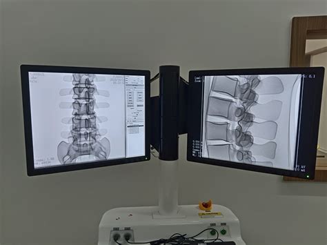 Our Ce Certified Plx118f Mobile Digital Fpd C Arm System Is Now