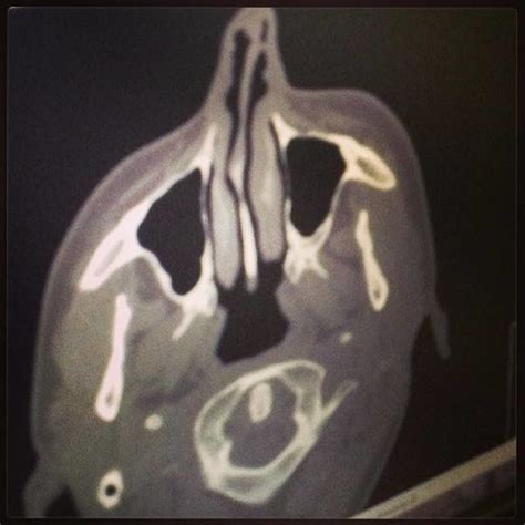 I Have Deviated Septum Photo Rhinoplasty Cost Pics Reviews Qanda