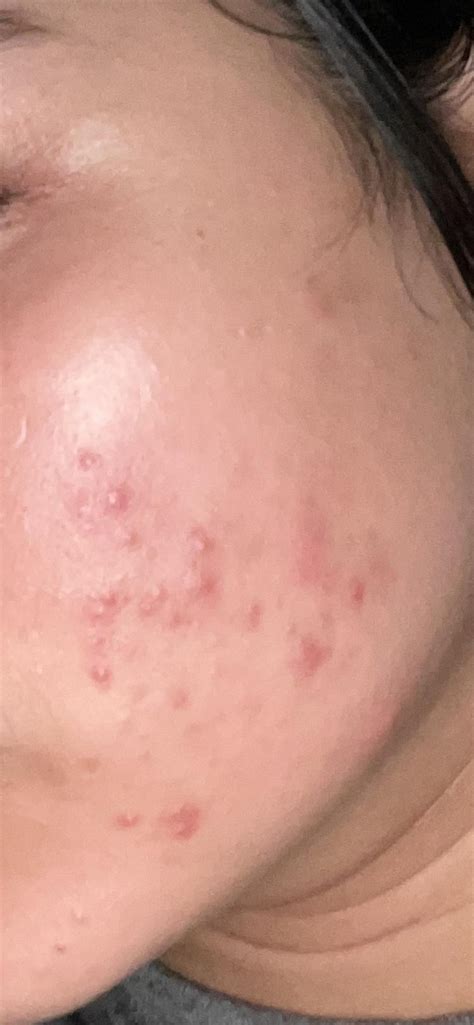 Cheek Acne Rskincareaddiction