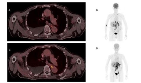 Two Radiotracers Work Better Than One For Cancer Imaging Physics World