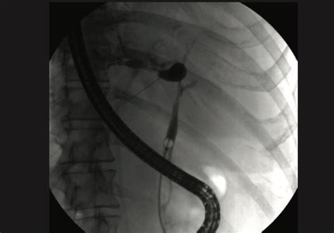 Endoscopic Diagnosis And Management Of Cholangiocarcinoma Practical Gastro