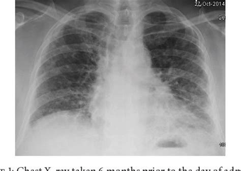 Interstitial Lung Disease X Ray