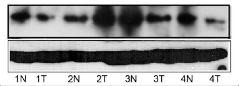 Mgmt And β Actin Expression Status In Esophageal Cancer Patients Was
