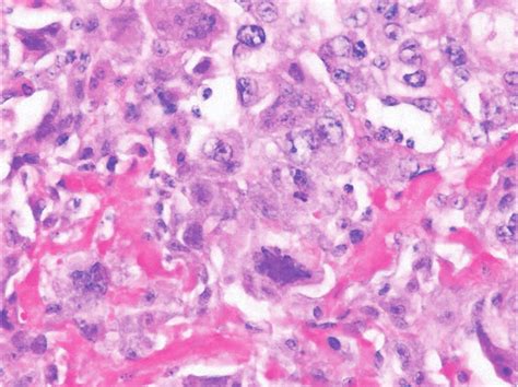 Osteoblastic Osteosarcoma Of Breast Showing Sheets Of Large Pleomorphic