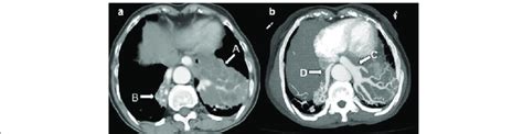 A On Chest Ct Transverse Section Aberrant Lung Tissue In The