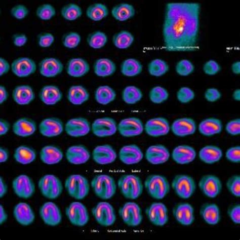 Nuclear Stress Test Showing Fixed Perfusion Defect In The Inferior Wall Download Scientific