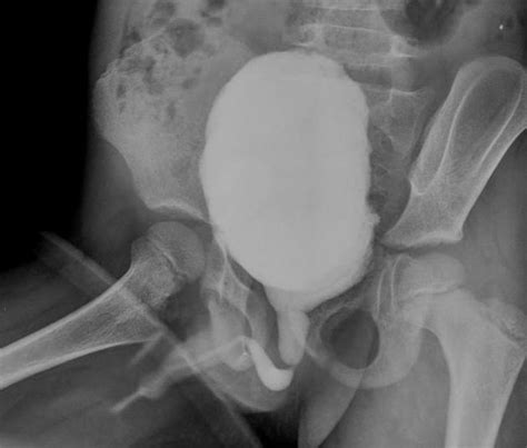 Posterior Urethral Valves Pacs