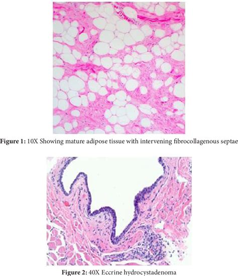 Figure 2 From A Clinically Intriguing Case Of One Sided Axillary Lipoma And Other Sided Axillary Figure 2 From A Clinically Intriguing Case Of One Sided Axillary Lipoma And Other Sided Axillary