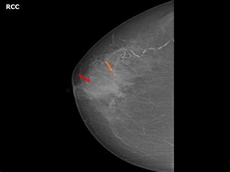 Atlas Of Breast Cancer Early Detection