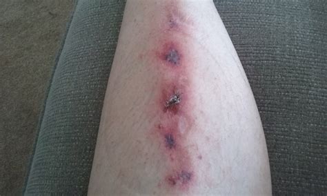 Cutaneous Vasculitis Flare Up Im Vasculitis Uk