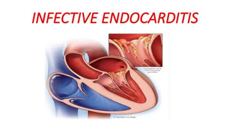 Infective Endocarditis A Pediatric Over Viewpptx