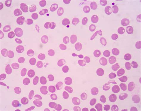 Beta Talasemia Causas Síntomas Diagnóstico Y Tratamiento Doctor Online