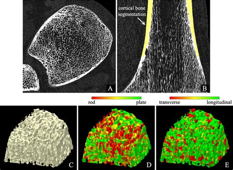 In Vivo Imaging Of Bone Microstructure On A Siemens Sommatom Force Ct Download Scientific