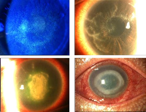 Acanthamoeba Keratitis Associated With Contact Lens Wear In Singapore