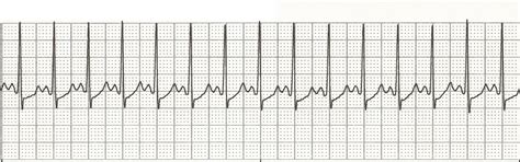 Cropped Sinus Tachy Test Strip Rainier Olympic Nurses Association