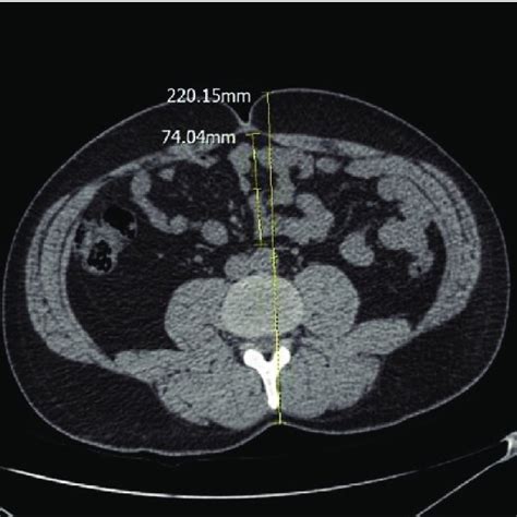The Mesenteric Fat Tissue Thickness Ratio Was Assessed As Follows The