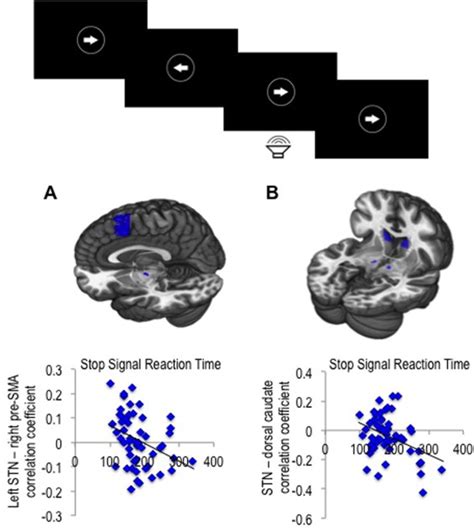 Neural Correlates Of Motor Response Inhibition Stop Signal Task Top