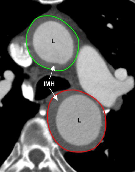 Patient 1 Computed Tomographic Image Shows Intramural Hematoma Imh