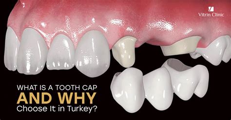What Is Tooth Cap And Why Choose It In Turkey Vitrin Clinic