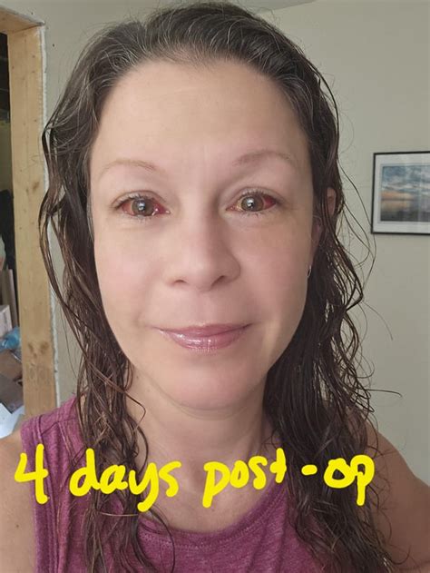 5 Days Post Op R Strabismus