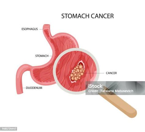 Ilustración De Cáncer De Estómago Tumor Canceroso Maligno Agrandado