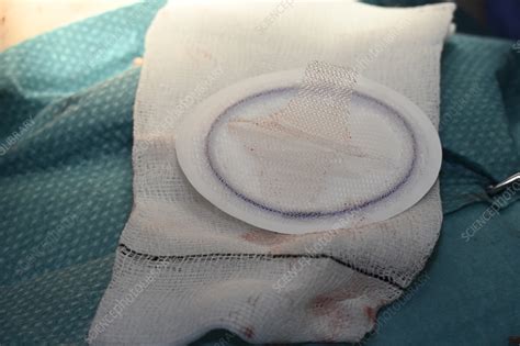 Hernia Mesh Stock Image C057 5358 Science Photo Library