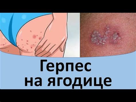 Герпес на попе (ягодицах) - причины и лечение, с фото.