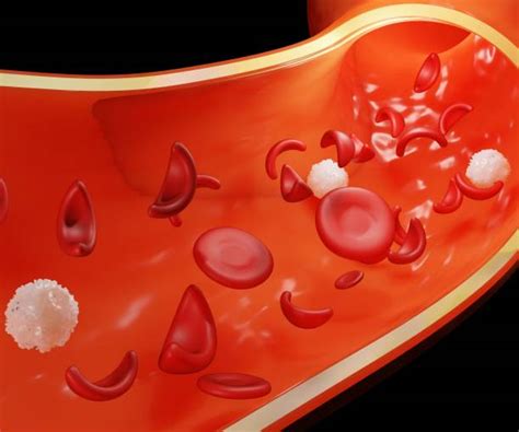 280 Anemia Sel Sabit Ilustrasi Foto Stok Potret And Gambar Bebas