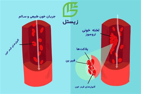 لخته شدن خون در بدن شناسایی علائم و درمان فوری زیستل