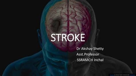 Cva Cerebrovascular Accident Stroke Pptx