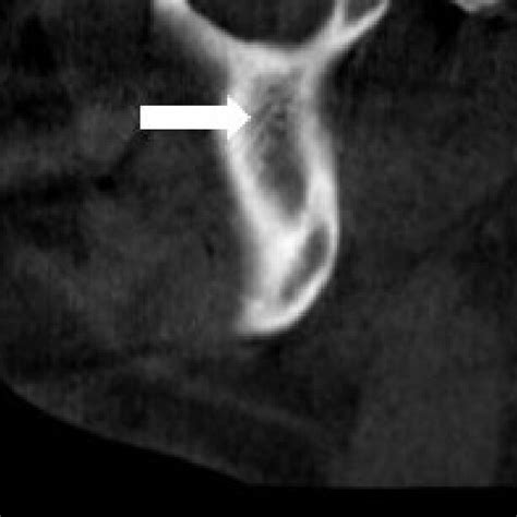 Sagittal Section Of Cbct Illustrating Type B Canals Ran Between The Download Scientific
