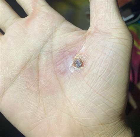 Salicylic Acid On Wart Rwarts