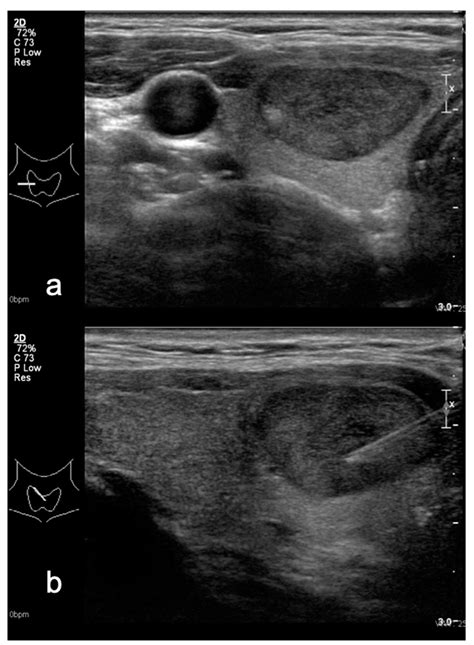 Thyroid Nodule Ultrasound