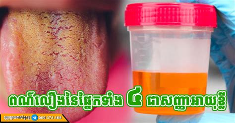 ៤ ផ្នែកនៃរាងកាយ ដែលមានពណ៌លឿង បង្ហាញថា អ្នកមានជំងឺ អាយុខ្លី Knongsrok