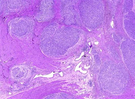 Who Gi Mesenchymal Random Tumors Genetic Syndromes Flashcards Quizlet